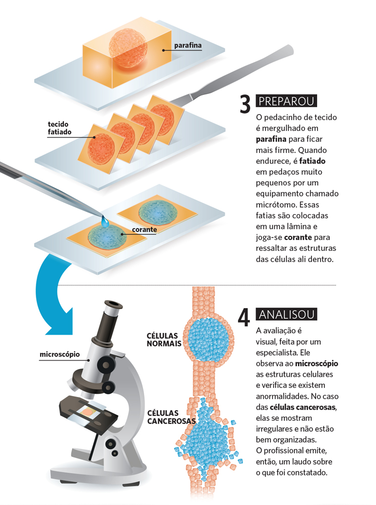 Como é feita uma biópsia? | Veja Saúde