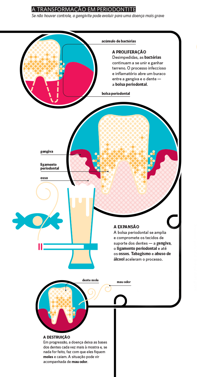 O que é a gengivite? Saiba como prevenir e tratar | Veja Saúde