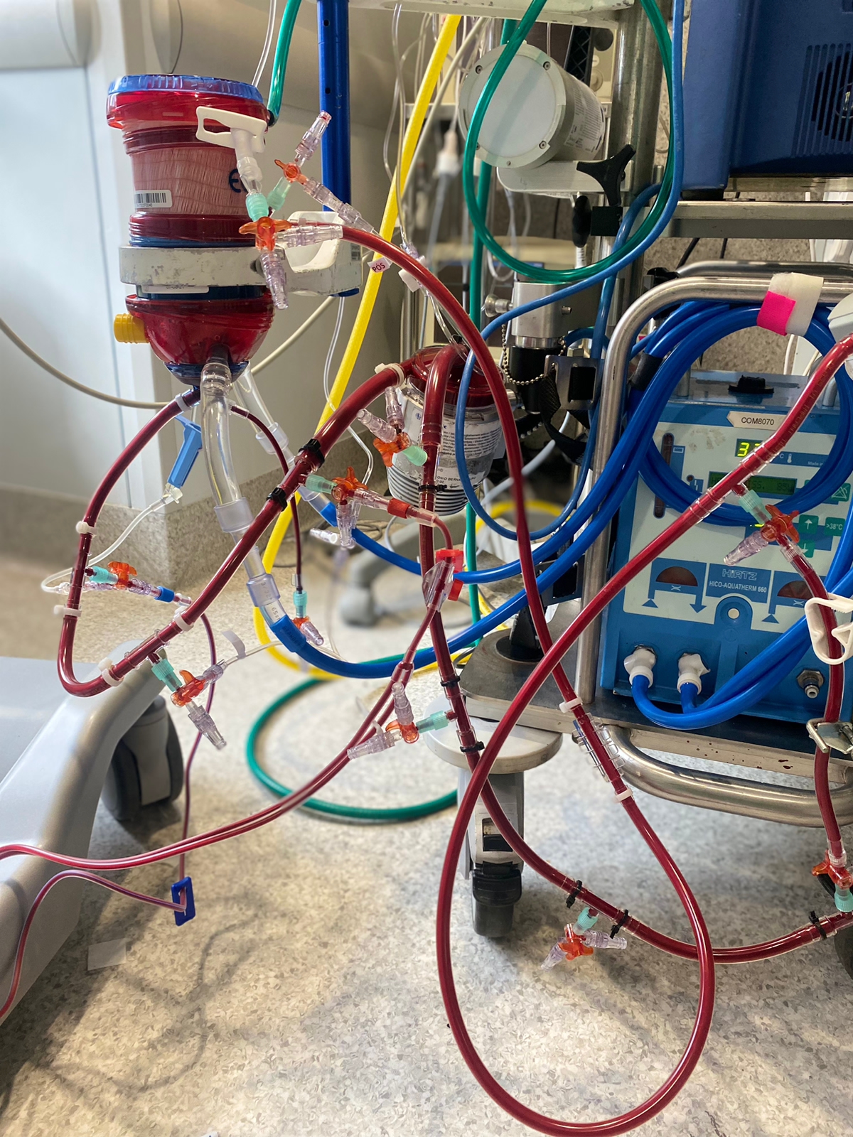 Você já ouviu falar em ECMO e como ela pode ajudar a salvar vidas? | Veja Saúde